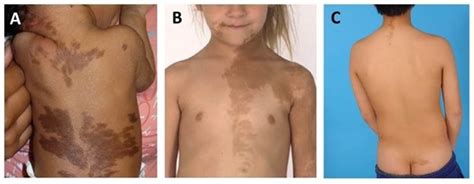 Figure 1 Hyperpigmented Macules Genereviews® Ncbi Bookshelf