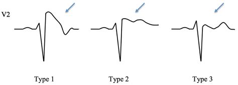 Brugada Syndrome Causes Ecg Symptoms Treatment