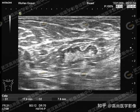 三例乳腺肿块超声诊断 知乎