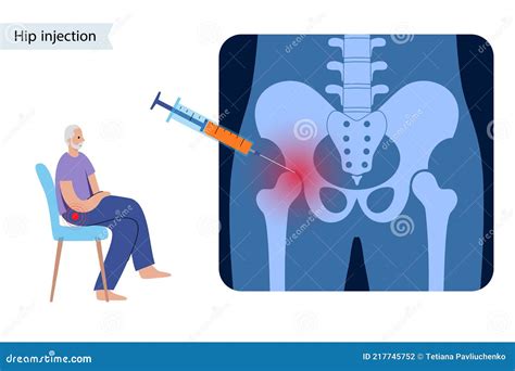 Hip Joint Injection Stock Vector Illustration Of Femoral 217745752