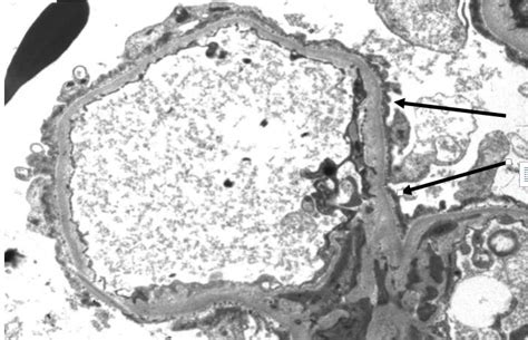 A Patient With Focal Segmental Glomerulosclerosis Renal And Urology News