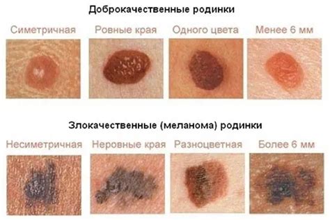 Виды родинок 60 картинок