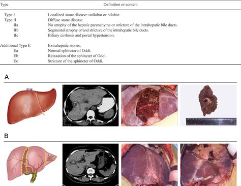 Table 1 From Classification And Management Of Hepatolithiasis A High