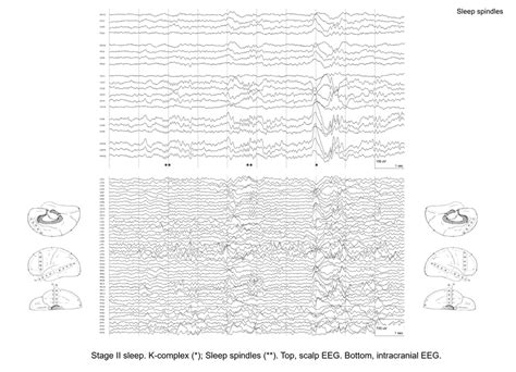 Fig1 Stage 2 Sleep Combined Scalp Intracranial Eeg Download High
