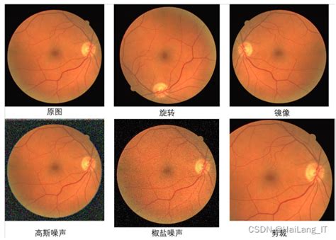 毕业设计 基于机器视觉的视网膜血管医学影像分割 语义分割基于视觉的视网膜 Csdn博客
