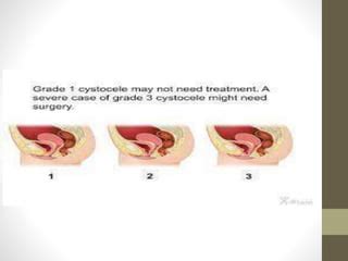 Cyctocele Pptx