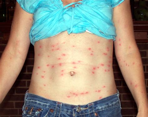Chigger Bites Pictures And Treatment