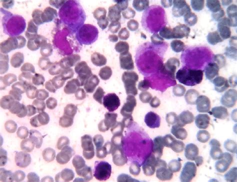 Basophilia Observed In Blood Smear Of The Patient Download Scientific Diagram