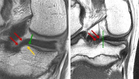 Meniscal Root Tears Posterior Horn Meniscus Part 2 Radiology