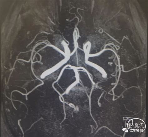 脑血管影像案例（38）：心脏室壁瘤伴血栓形成所致栓塞性脑梗死 脑医汇