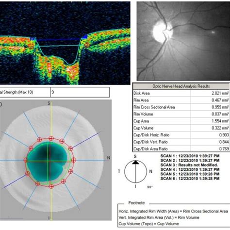 Optic Nerve Head Analysis Using Optic Disc Download Scientific Diagram