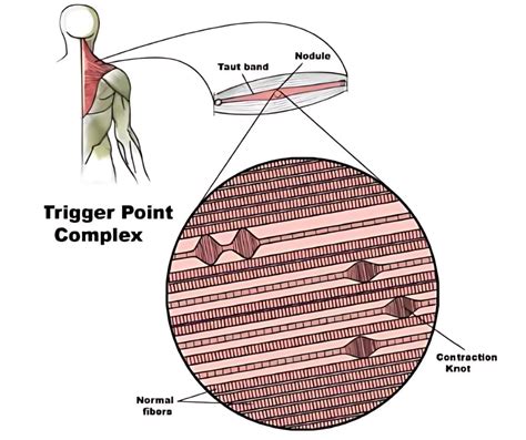 Exploring The Science Behind Dry Needling An Overview