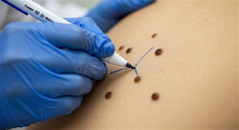 Mole Mapping Doctor Examining Skin Moles For Cancer Dermatologist Checks For Melanoma Early