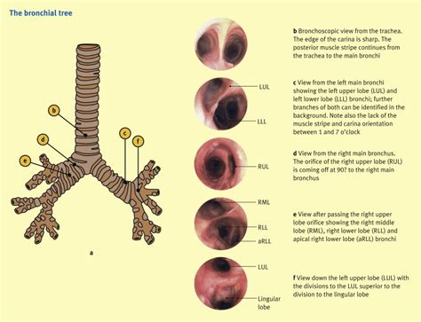 Bronchoscopic Anatomy Anaesthesia And Intensive Care Medicine