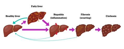 The Stages Of Long Term Liver Disease British Liver Trust