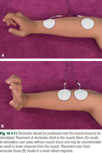 Clinical Electrical Stimulation Flashcards Quizlet