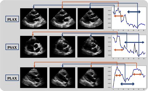 Figure 1 From Transformer Based Spatio Temporal Analysis For Classification Of Aortic Stenosis