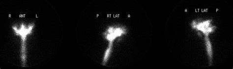 Nuclear Medicine Cisternogram Cerebrospinal Fluid Leak Imaging