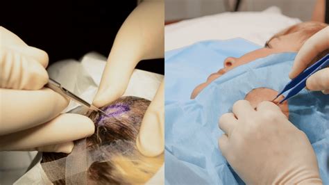 Pilar Cyst Vs Sebaceous Cyst Key Differences Obviousmag