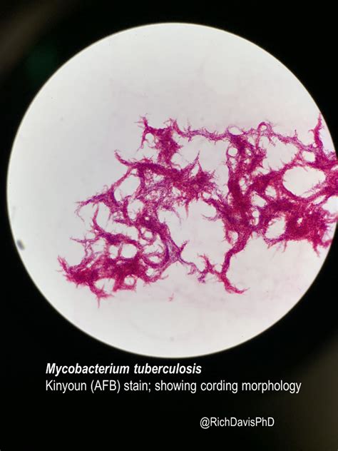 A Cording Too “cording” In Clinical Isolates Of Mycobacterium