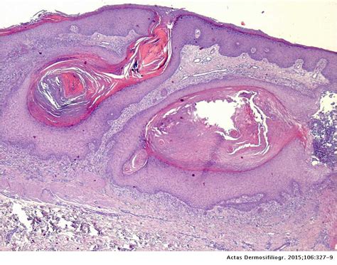 Phrynoderma After Biliopancreatic Diversion Actas Dermo Sifiliográficas
