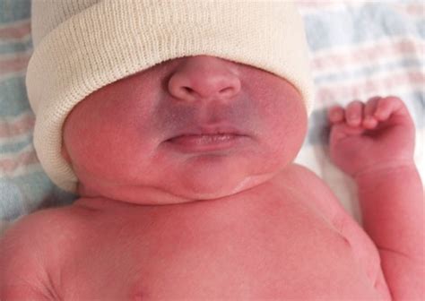 Circumoral Cyanosis Causes Symptoms Diagnosis Treatment Prevention Healthroid
