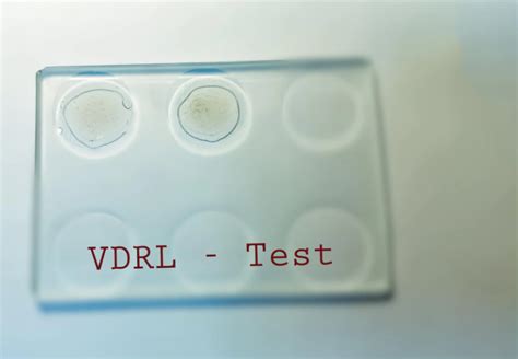 Vdrl Rpr For Syphilis