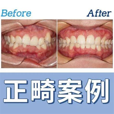 案例分享严重深覆合虎牙拥挤单晶托槽拔牙 矫正案例 程秀 治疗 牙齿