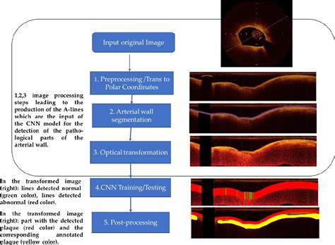 Figure 1 From Automatic Classification Of A Lines In Intravascular Oct Images Using Deep