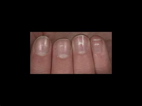 What Do Lines In Your Fingernails Mean Complete Guide And Key Details