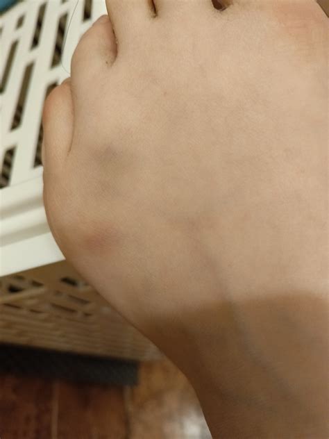 Пятна на ноге После приема ванны заметила пятна предварительно на венах Medaboutme