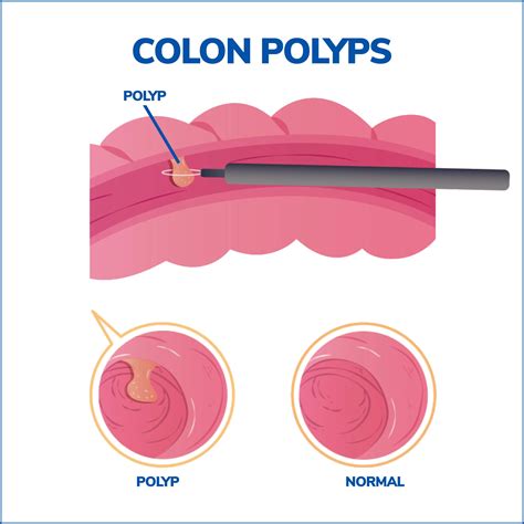 Understanding Colon Polyps Everything To Know