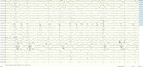 Invasive Electroencephalography Eeg 12 Sec Intracranial Eeg Page Download Scientific Diagram