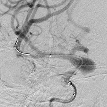A Year Old Male Patient Was Treated With A Single Mm Mm Download Scientific Diagram