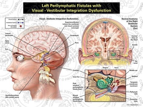 Female Left Perilymphatic Fistulas With Visual Vestibular Integration