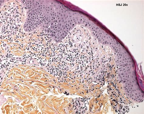 Lichen Striatus Human Pathology Photos Pictures