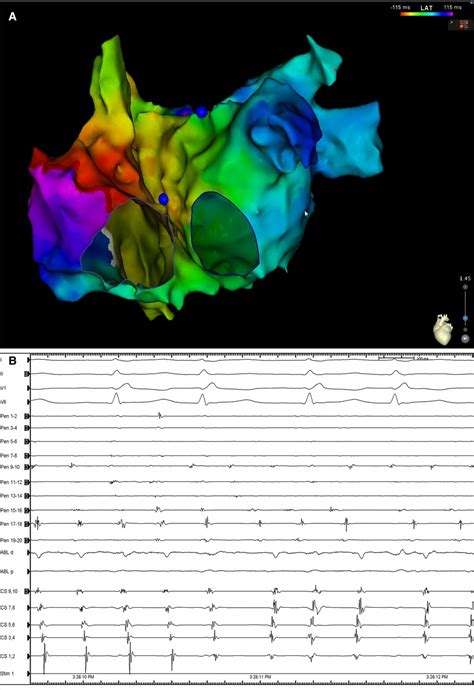 Frontiers Ongoing Substrate Driven Atrial Fibrillation Boxed” In The Left Atrial Posterior