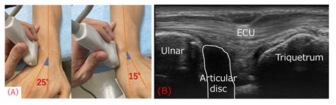 Motion Analysis Of The Extensor Carpi Ulnaris In Triangular