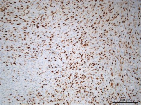 The Proliferation Index Was Very High Download Scientific Diagram