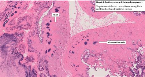 Bacterial Endocarditis Histology
