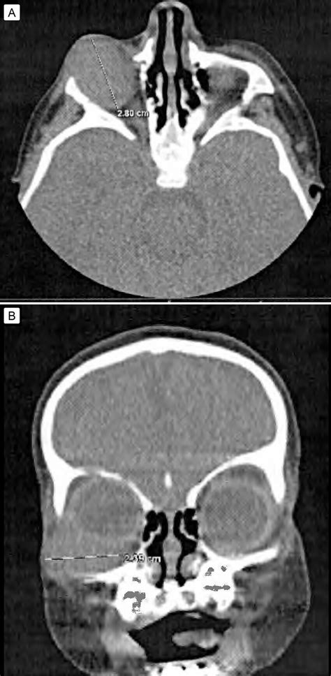 An Inferolateral Right Orbital Mass Causing Mass Effect And Superior Download Scientific
