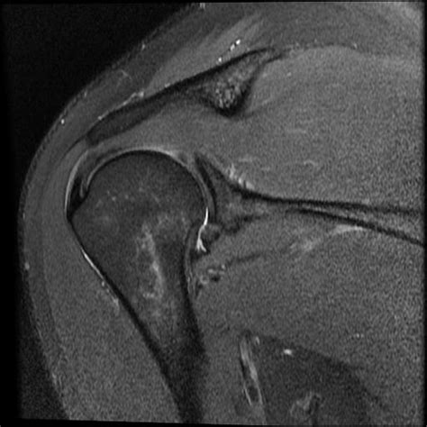 Bankart Lesion Mri