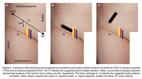 Femoral Nerve Block Landmarks
