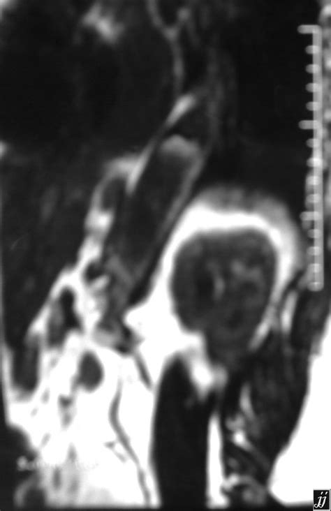 Abdomen Renal Artery Origin Stenosis With Aortic Dissection Mra 13