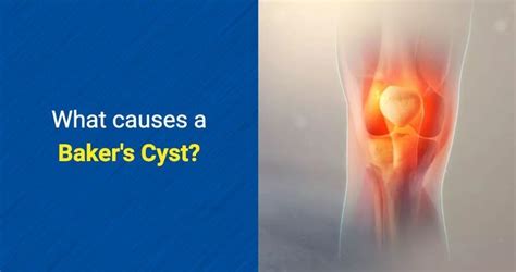 What Causes A Bakers Cyst Osmo Patch Us