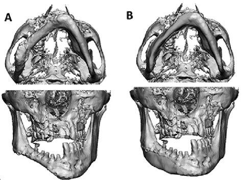 3d Reconstruction Of The Craniofacial Skeleton Actual Inferior View Download Scientific