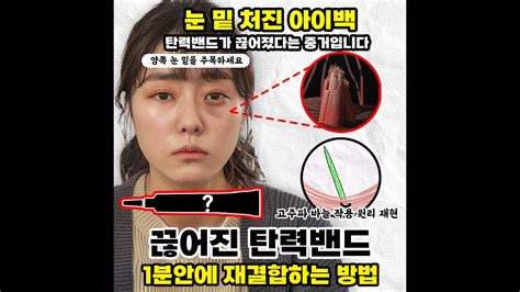 아이백 볼륨 리프팅 개선 임상 완료 Youtube