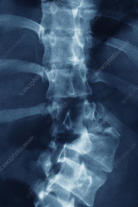 Vertebral Dislocation X Ray Stock Image C0555035 Science Photo