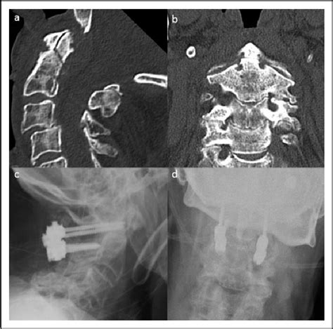 Figure 2 From Aospine—spine Trauma Classification System The Value Of Modifiers A Narrative