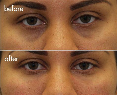 Do Under Eye Fillers Really Work To Fix The Tear Trough And Dark Circles Dr Brett Kotlus